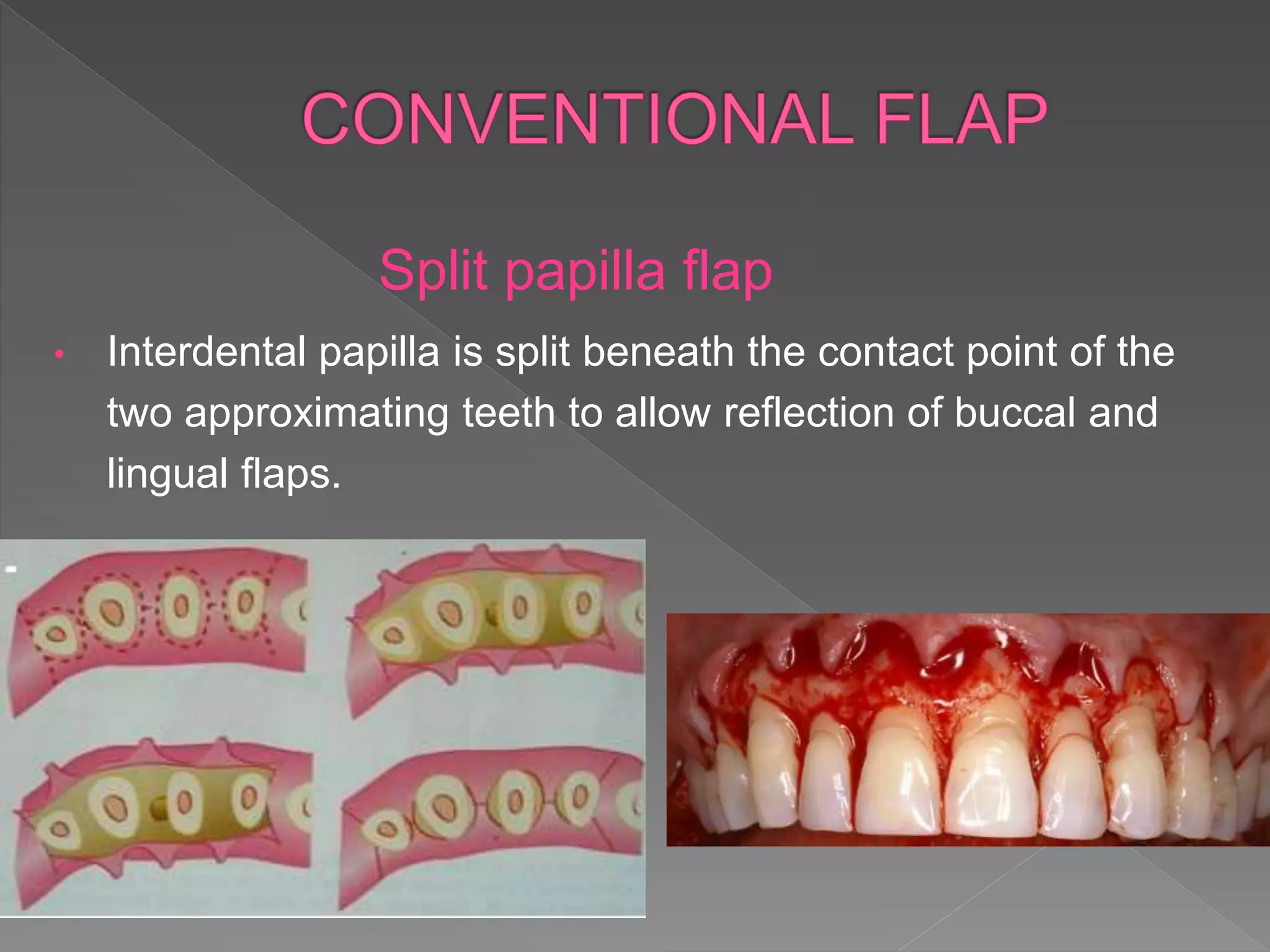 Periodontal flap | PPTX