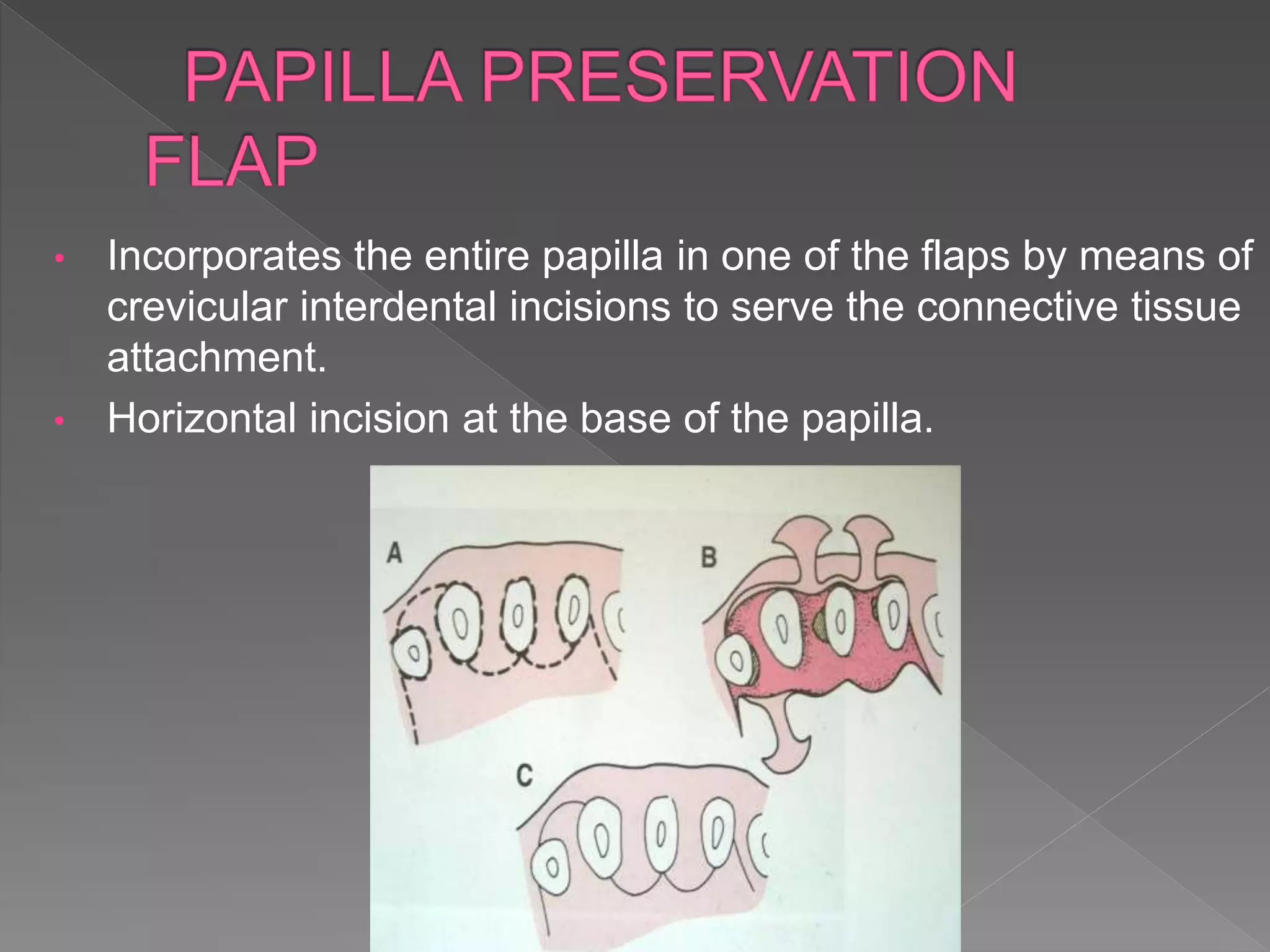 Periodontal flap | PPTX
