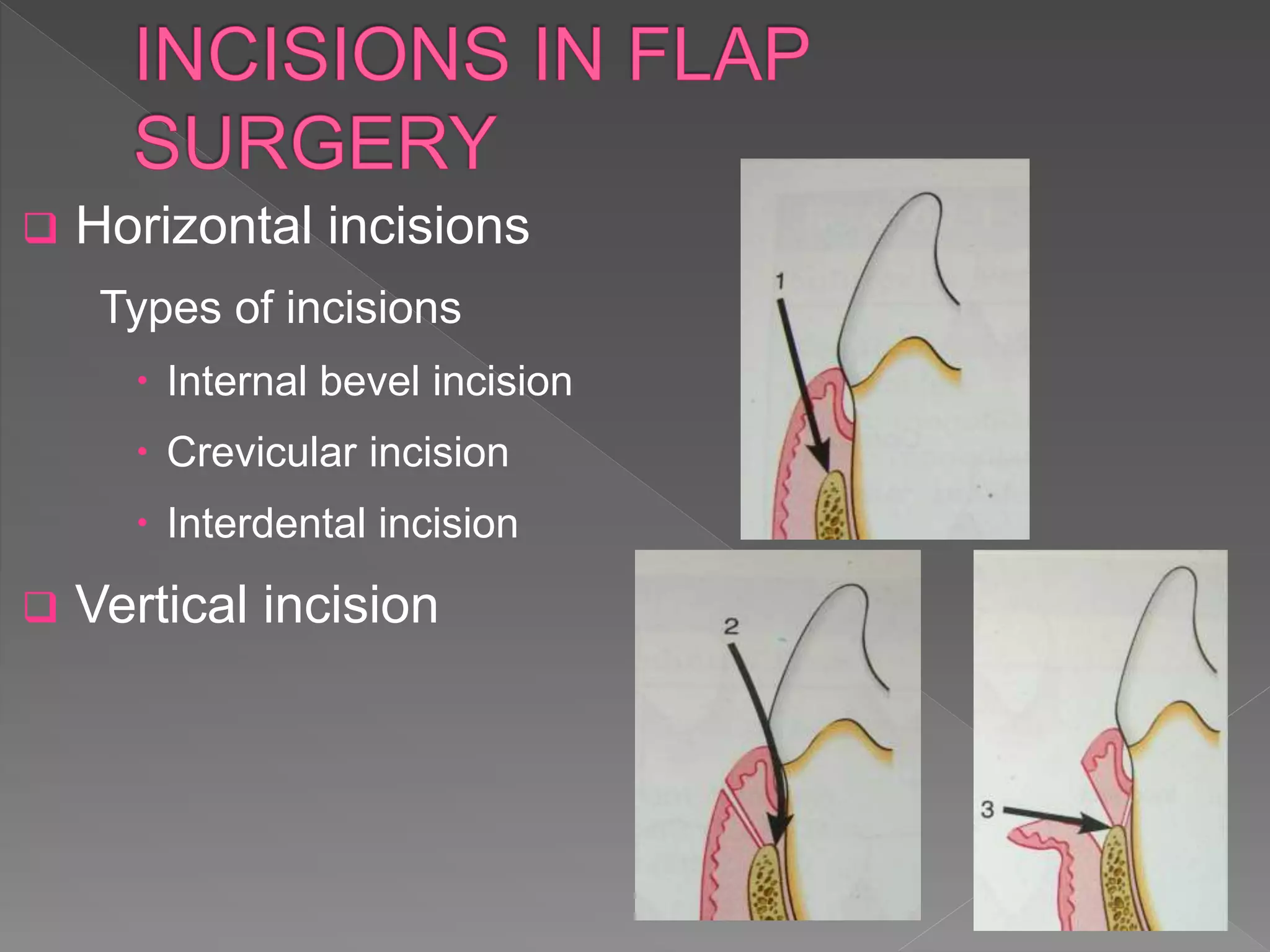 Periodontal flap | PPTX