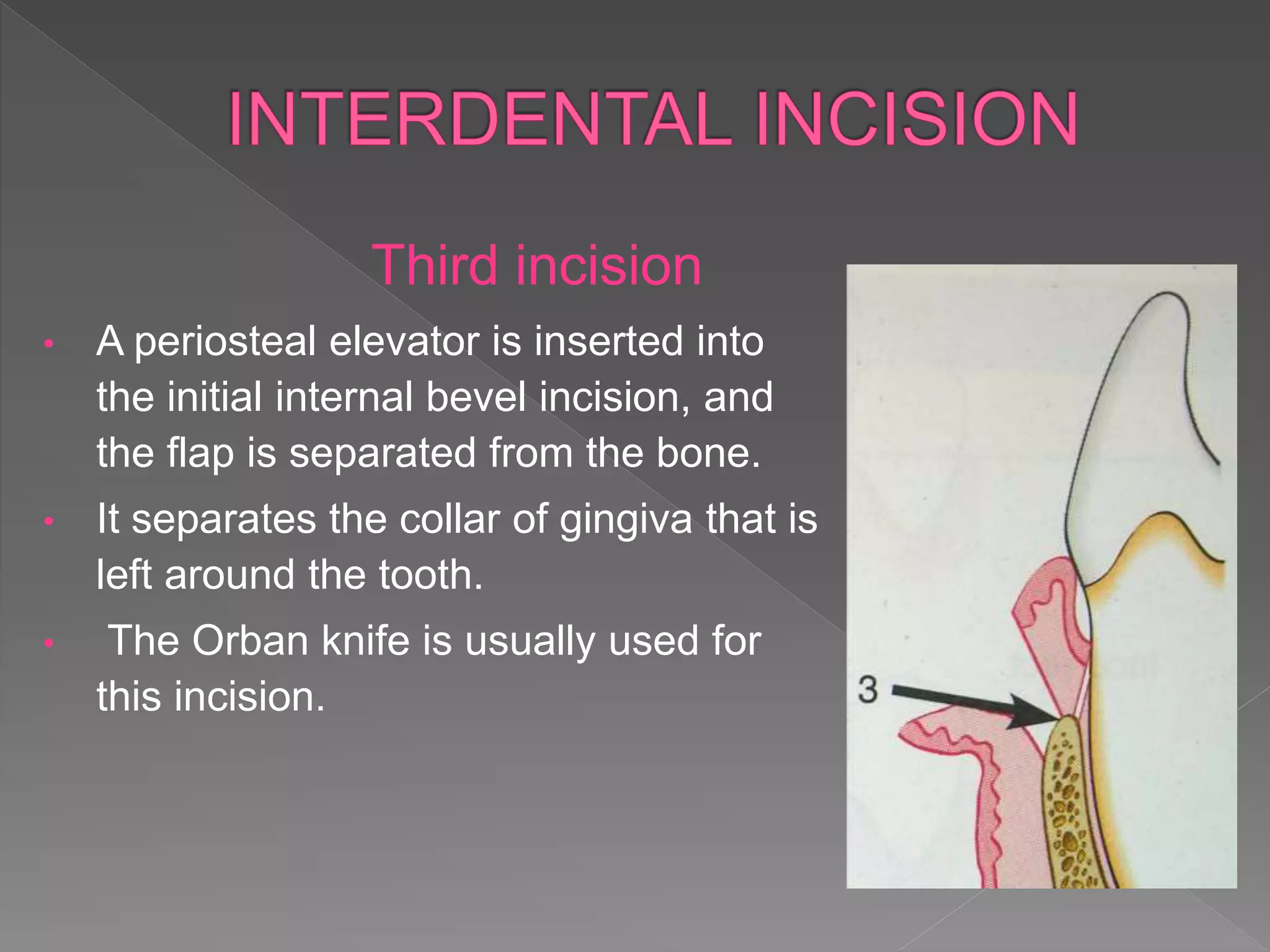 Periodontal flap | PPTX