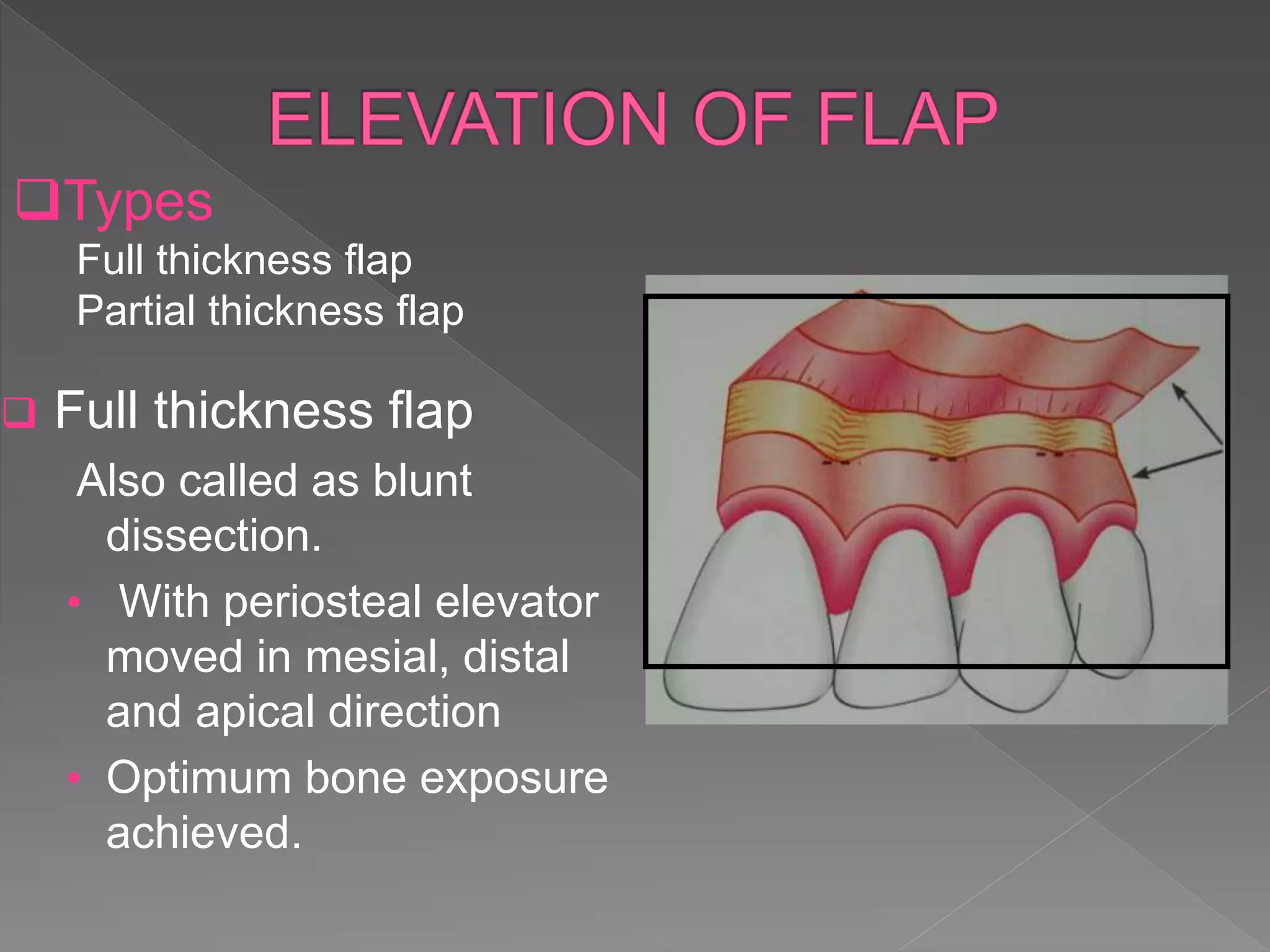 Periodontal flap | PPTX
