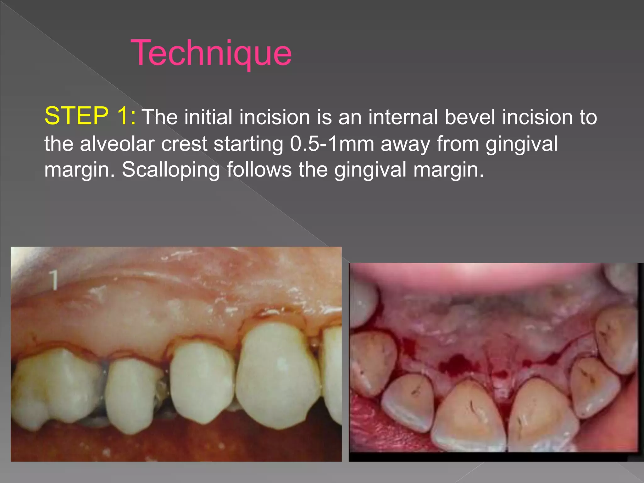 Periodontal flap | PPTX