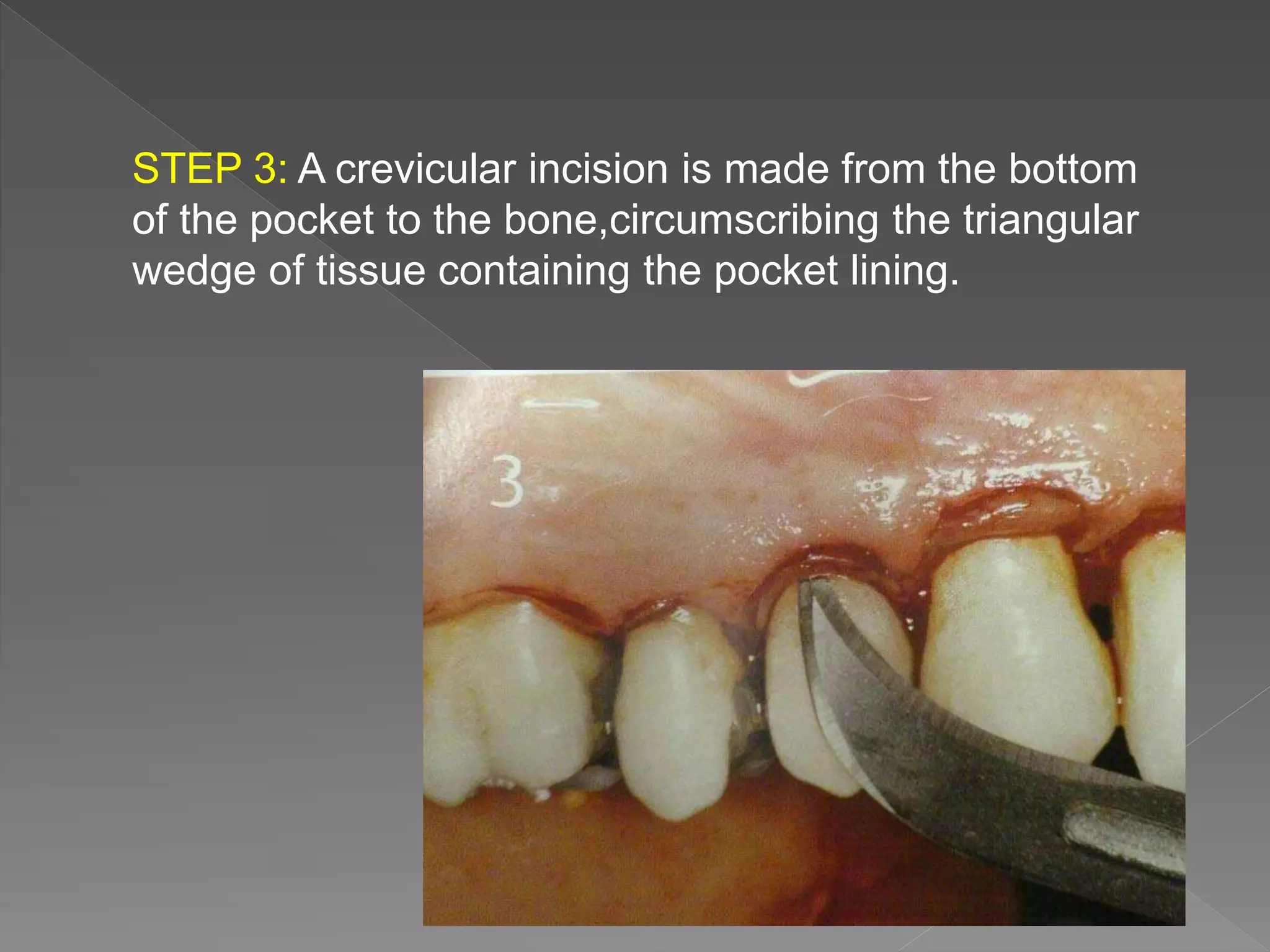 Periodontal flap | PPTX