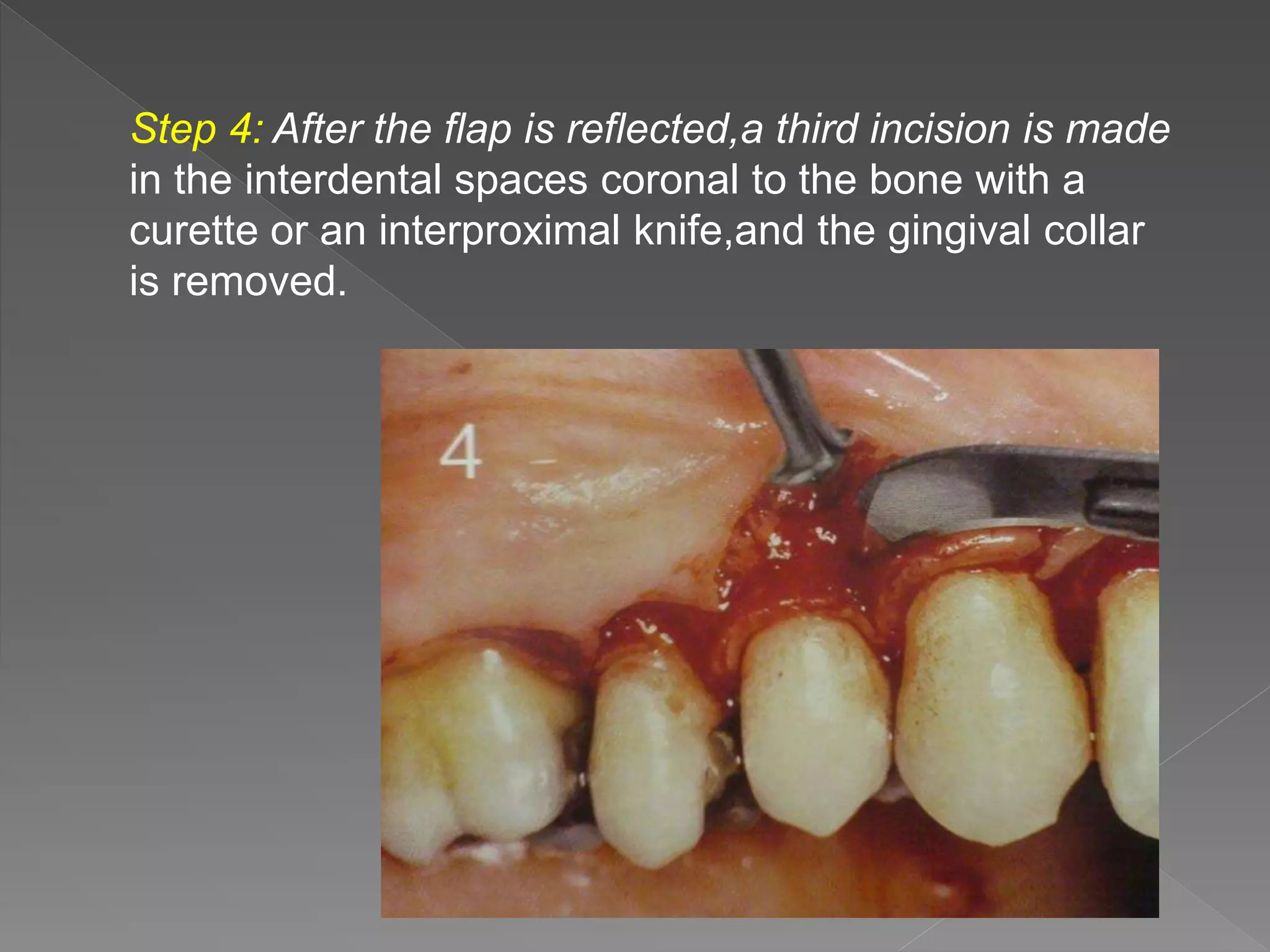 Periodontal flap | PPTX