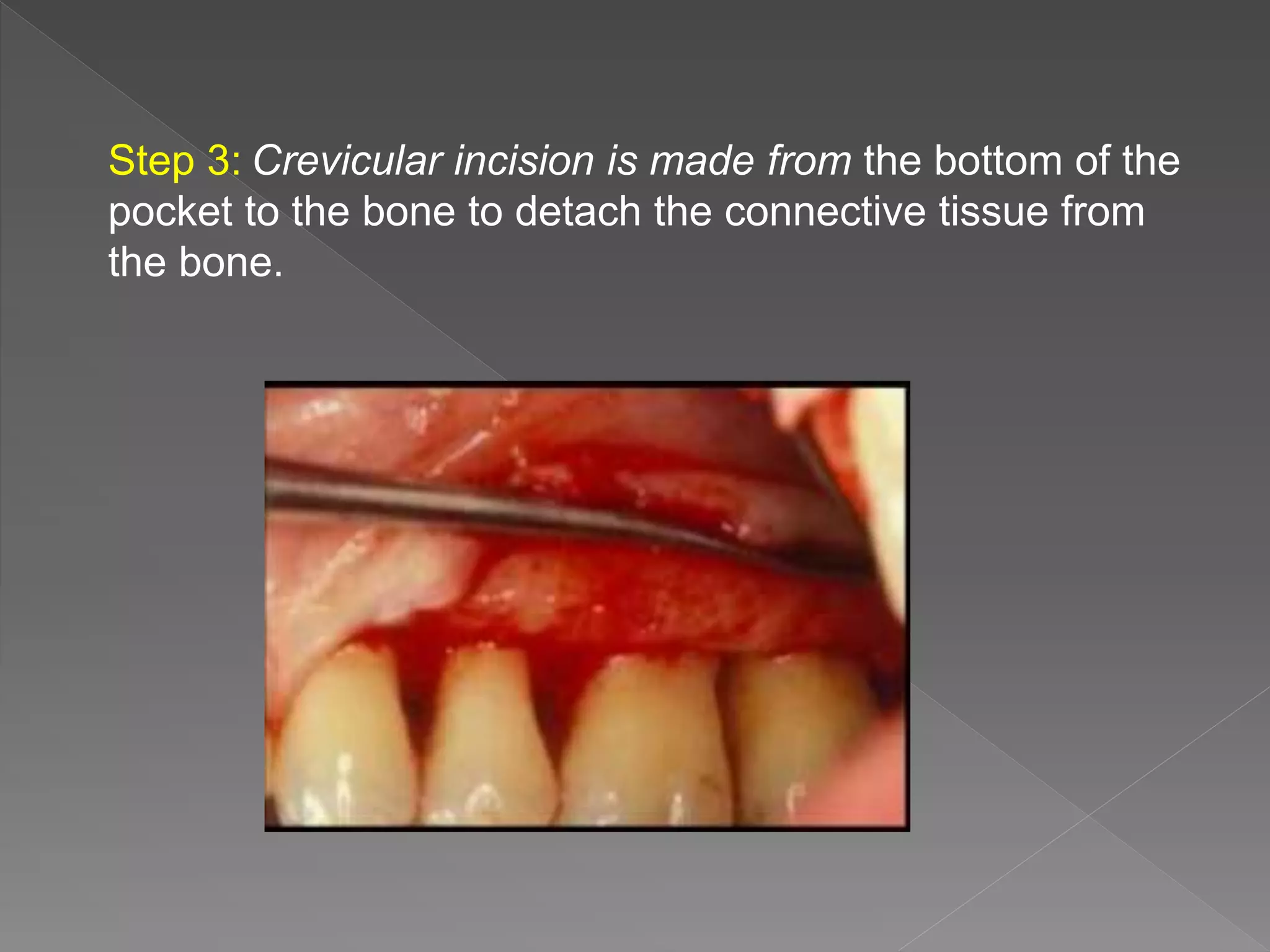 Periodontal flap | PPTX