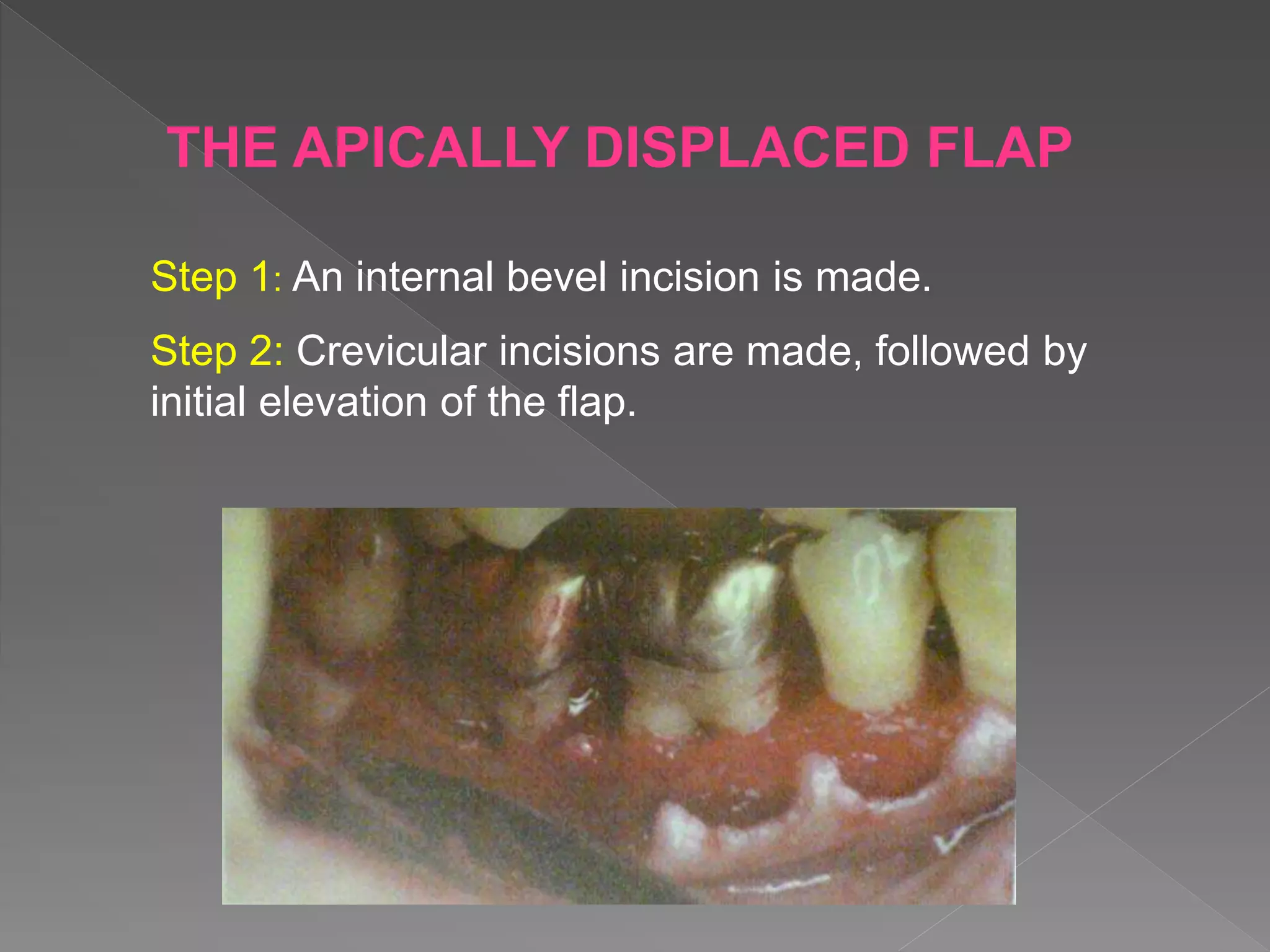 Periodontal flap | PPTX