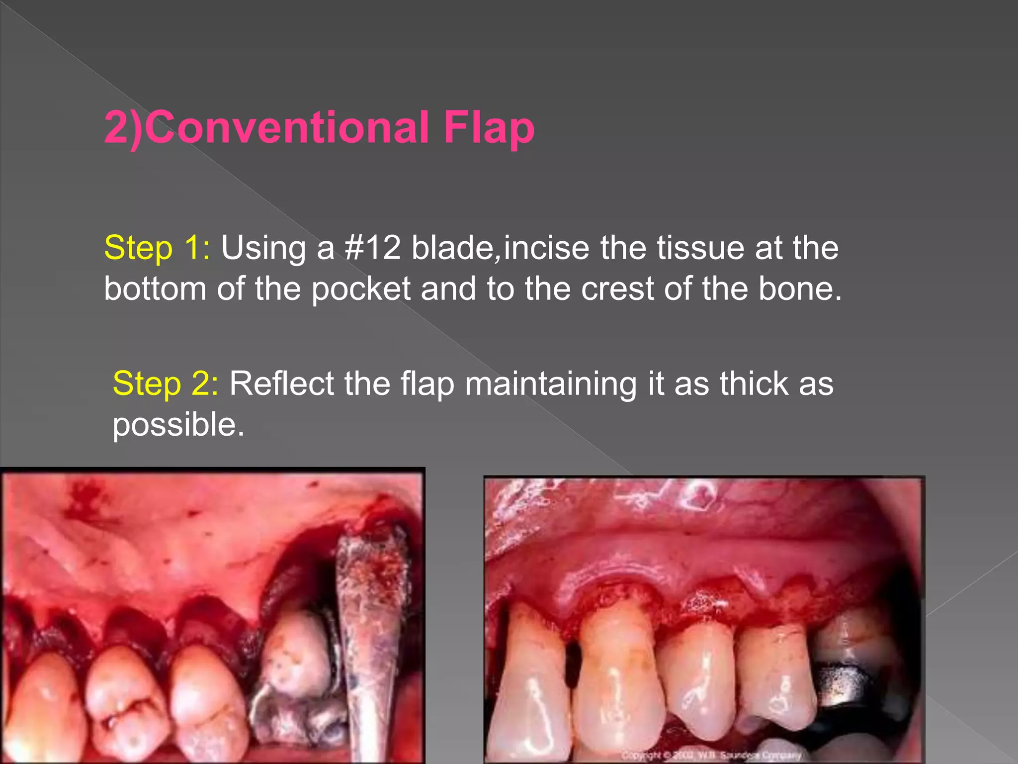 Periodontal Flap Pptx