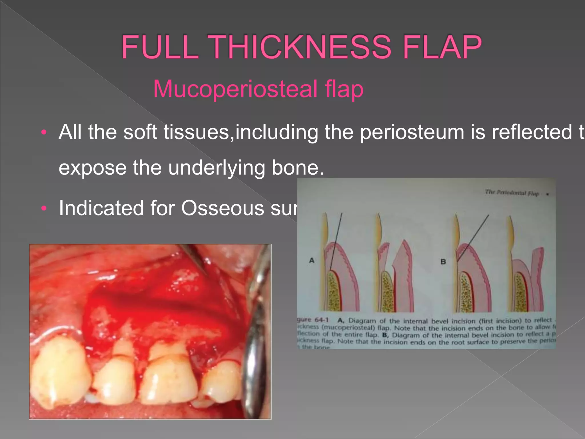 Periodontal flap | PPTX