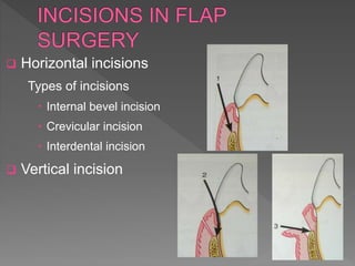 Periodontal flap | PPTX