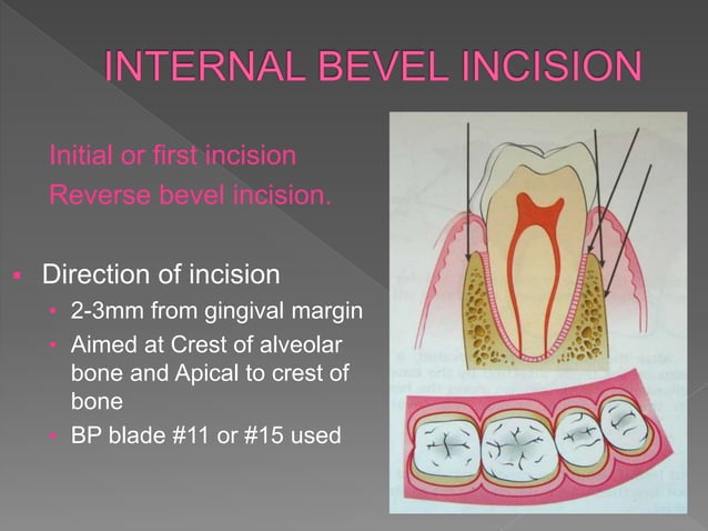 Periodontal flap | PPTX
