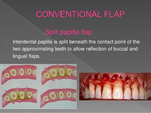 Periodontal flap