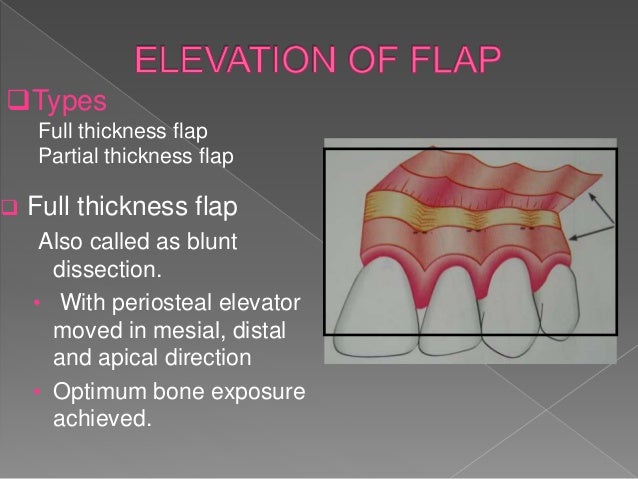 Periodontal flap
