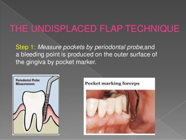 Periodontal flap