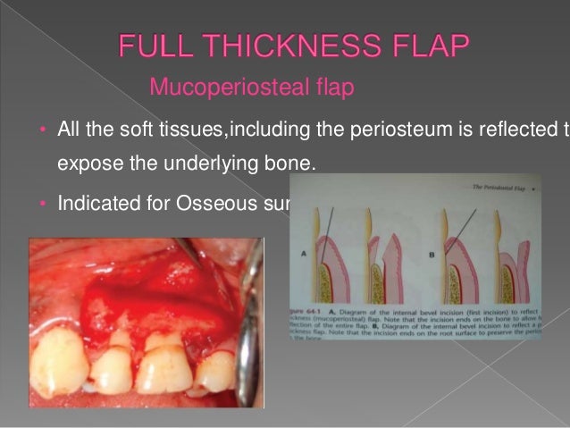 Periodontal flap