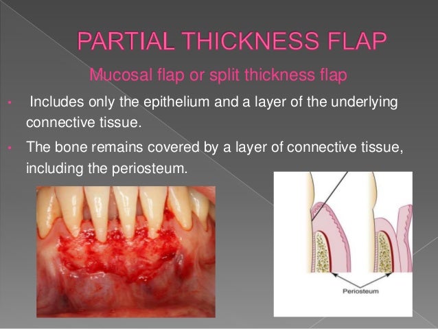 Periodontal flap