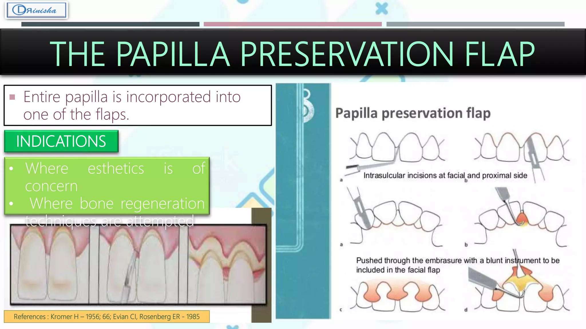 Periodontal flap | PPTX