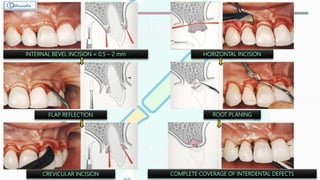 Periodontal flap | PPTX