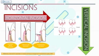 Periodontal flap | PPTX