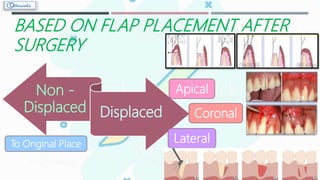 Periodontal flap | PPTX