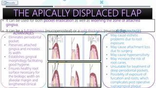 Periodontal flap | PPT