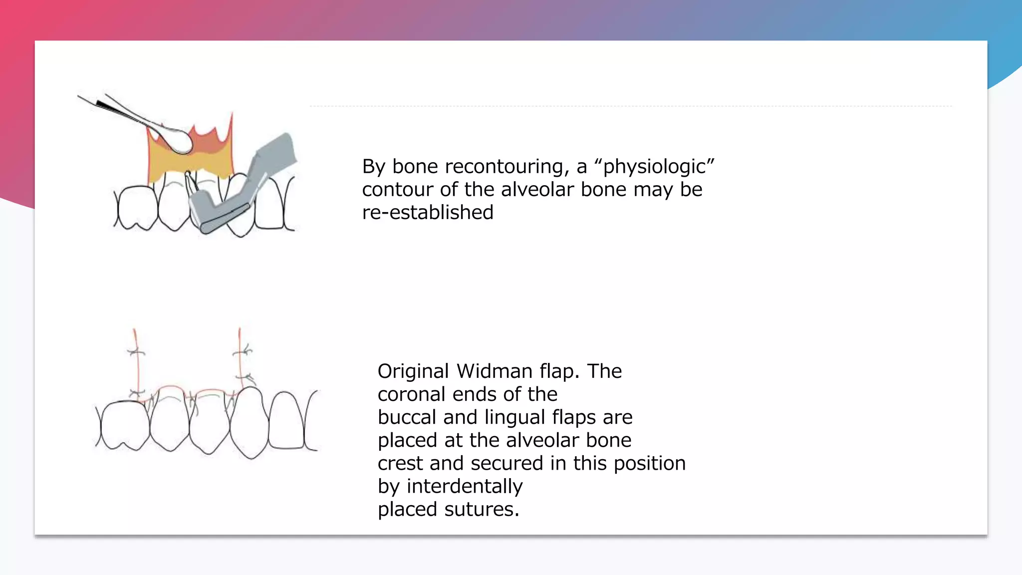 Periodontal flap design for access on osseous surgery | PPT