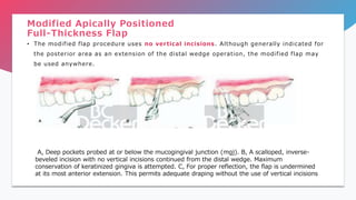Periodontal flap design for access on osseous surgery | PPT