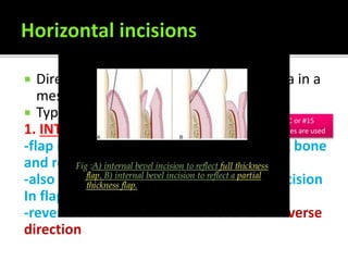 Periodontal flaps | PPTX
