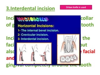 Periodontal flaps | PPTX
