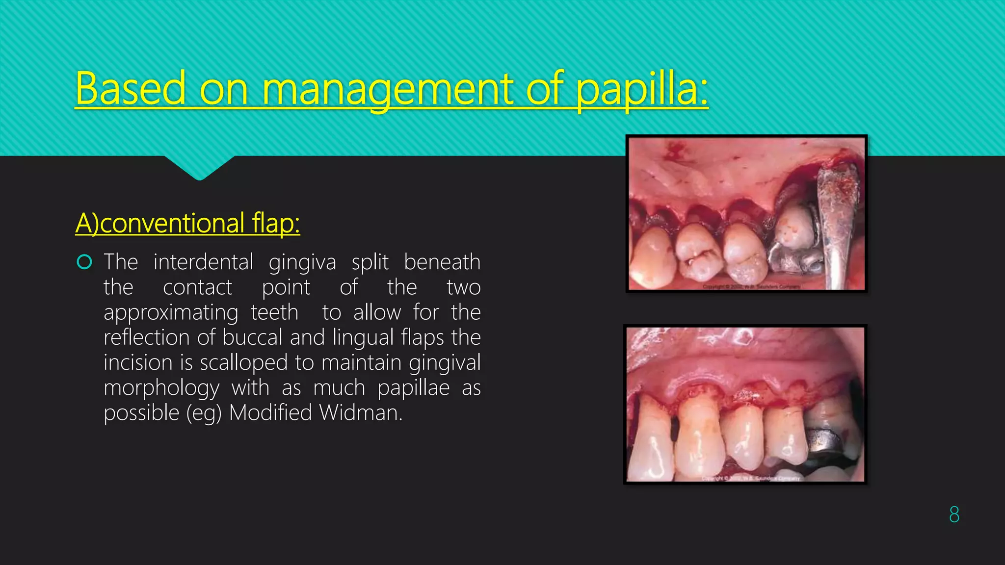 Periodontal flaps | PPTX