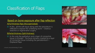 Periodontal flaps | PPTX