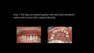 PERIODONTAL FLAPS.pptx