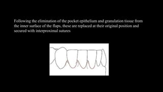 PERIODONTAL FLAPS.pptx