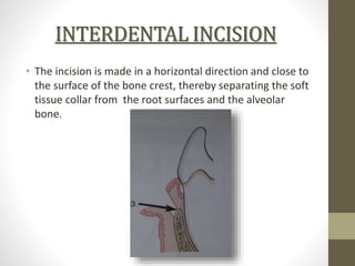 Periodontal flap surgeries by Dr. Jerry | PPTX