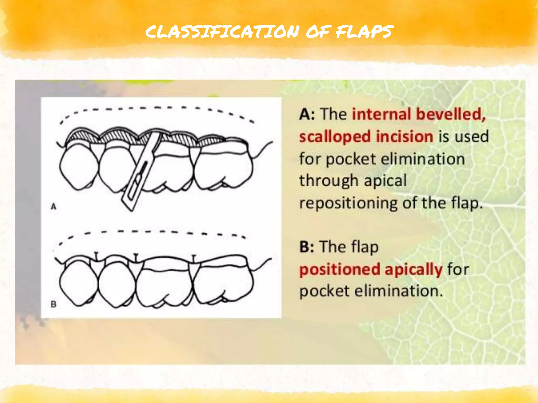 Periodontal flap surgery | PPTX
