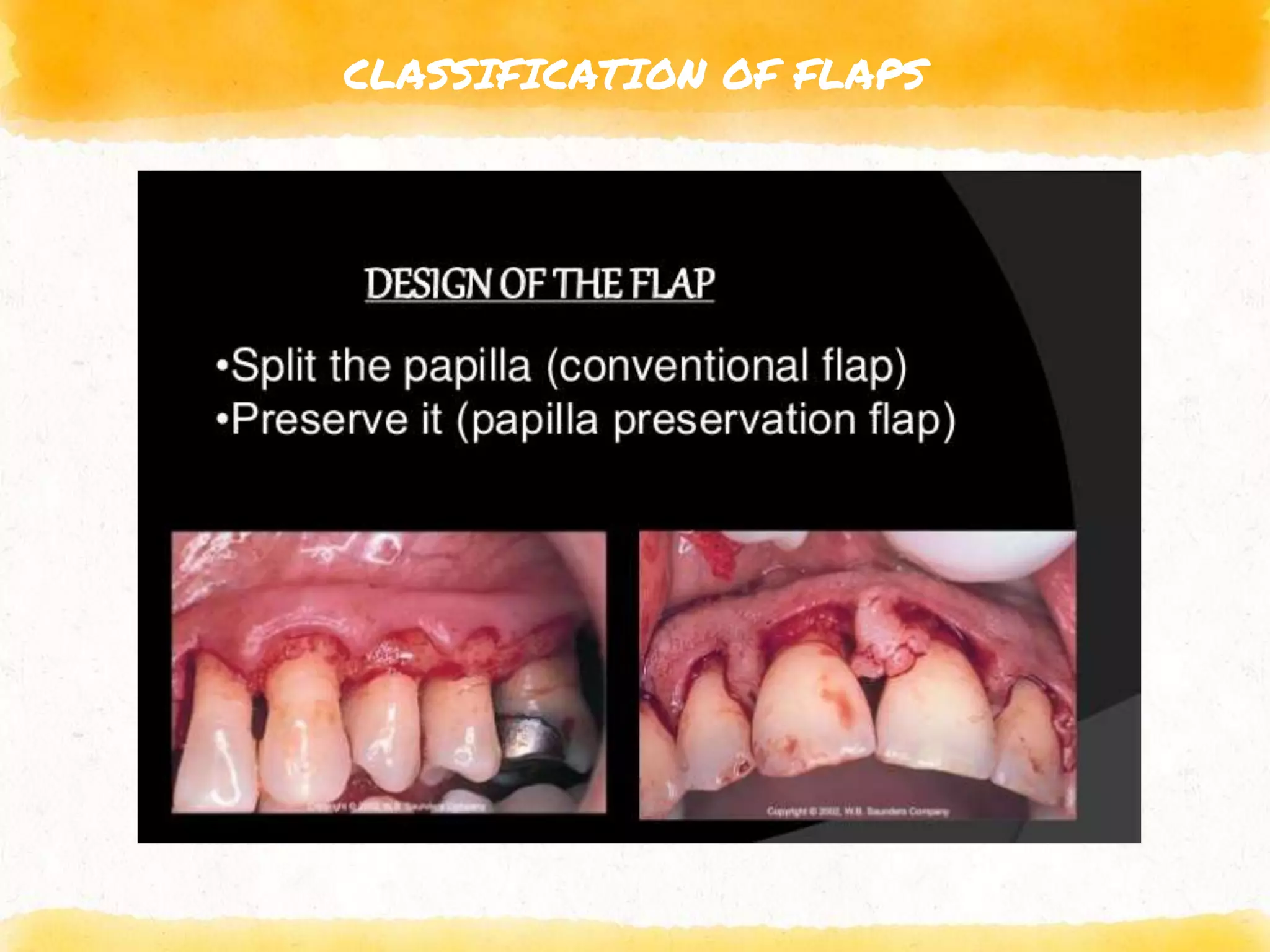 Periodontal flap surgery | PPTX