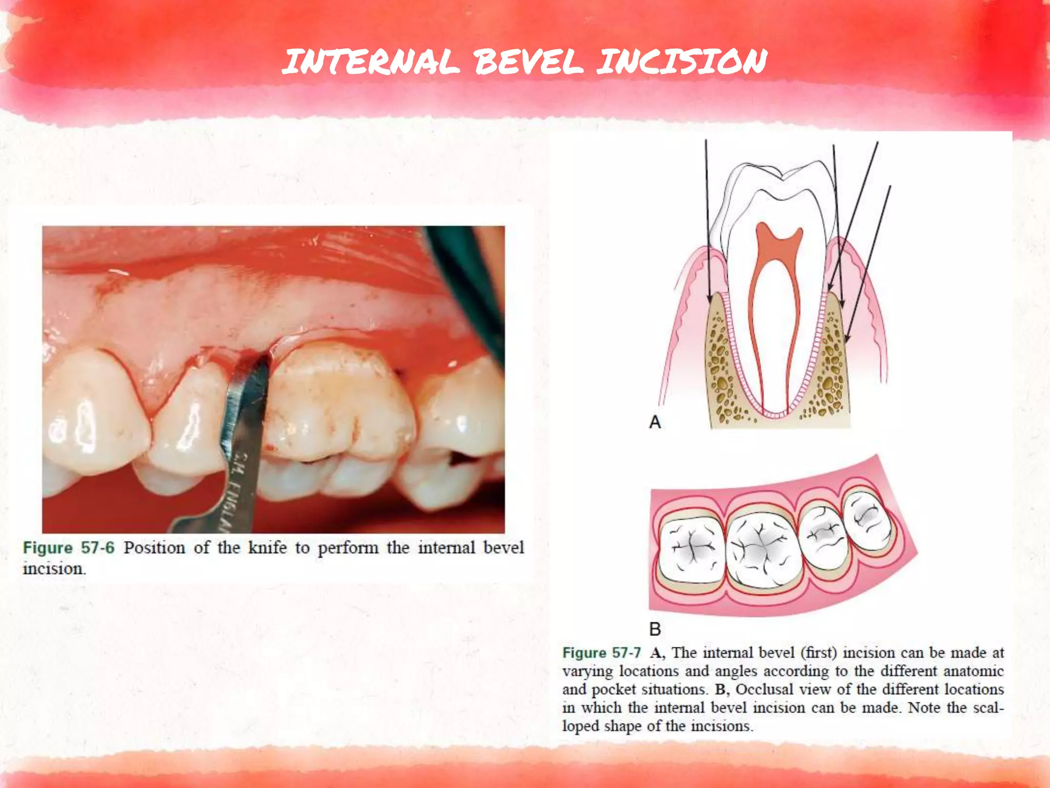 Periodontal flap surgery | PPTX