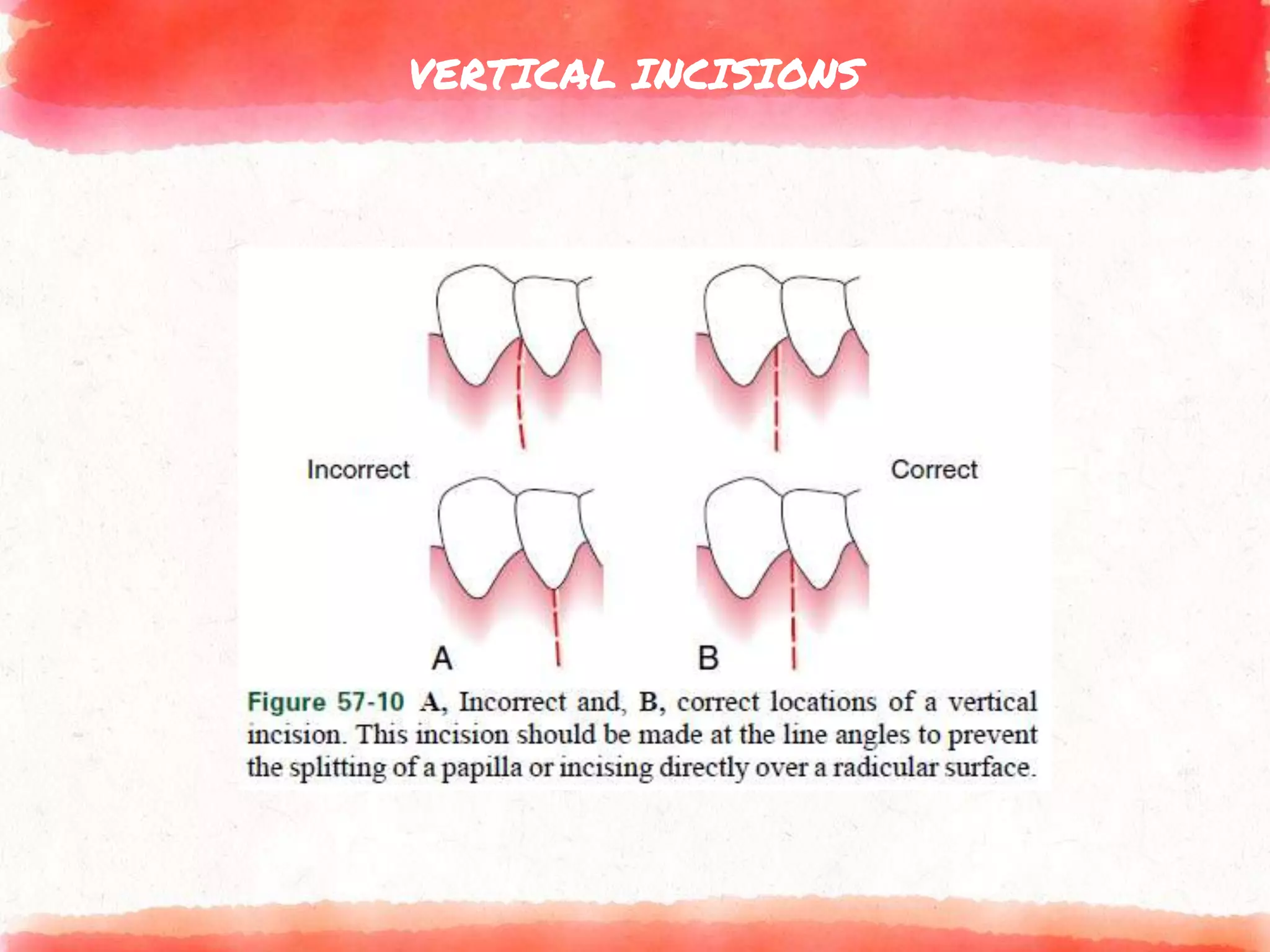 Periodontal flap surgery | PPTX