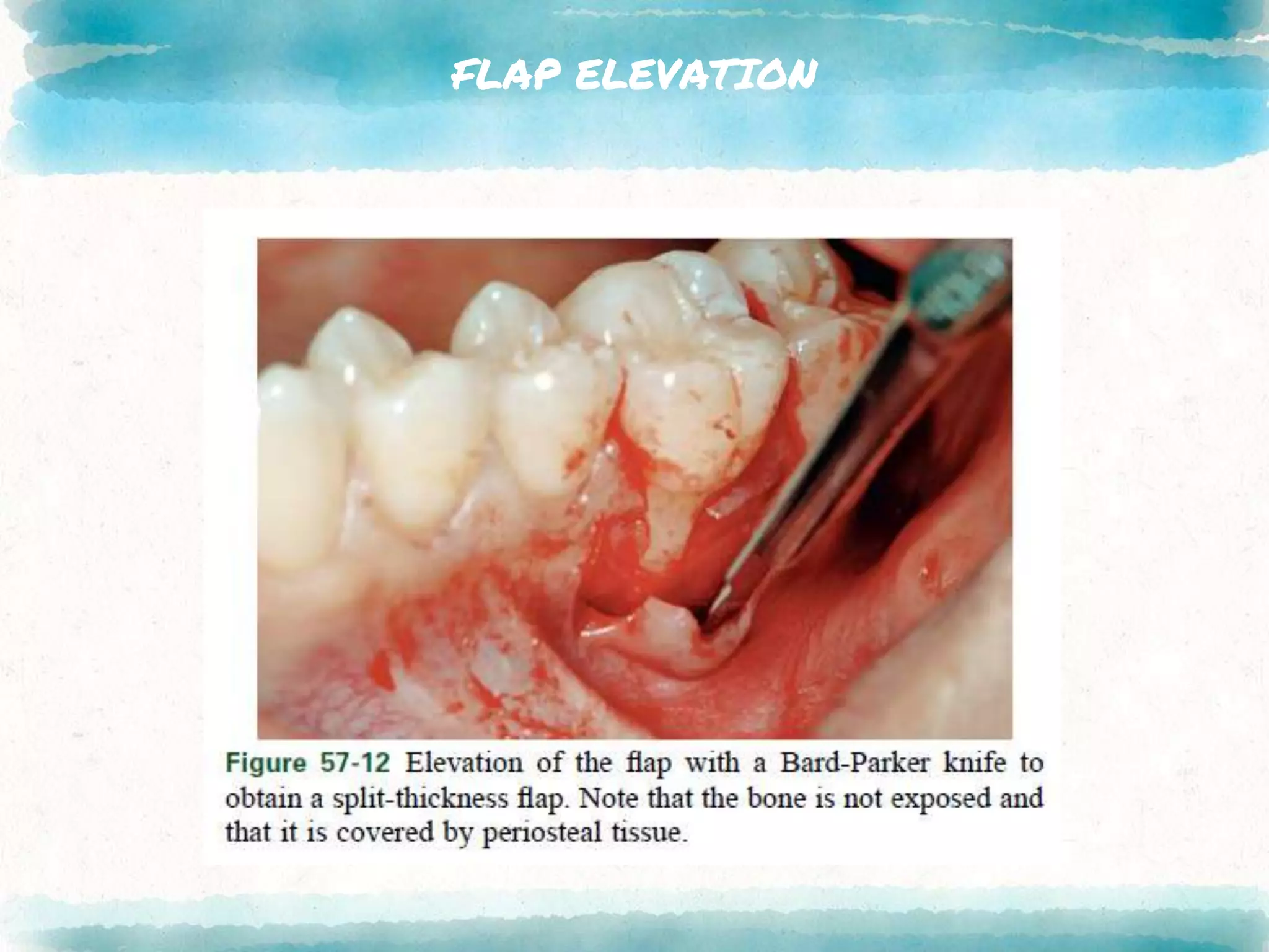 Periodontal flap surgery | PPTX
