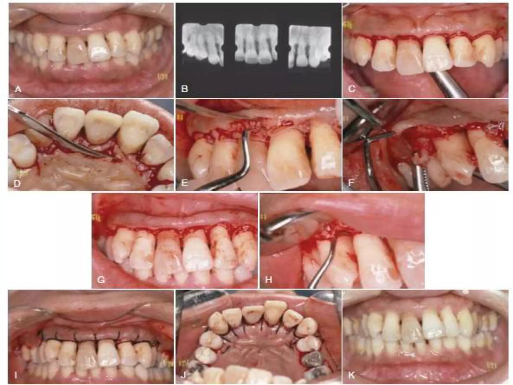 Periodontal flap surgery | PPTX