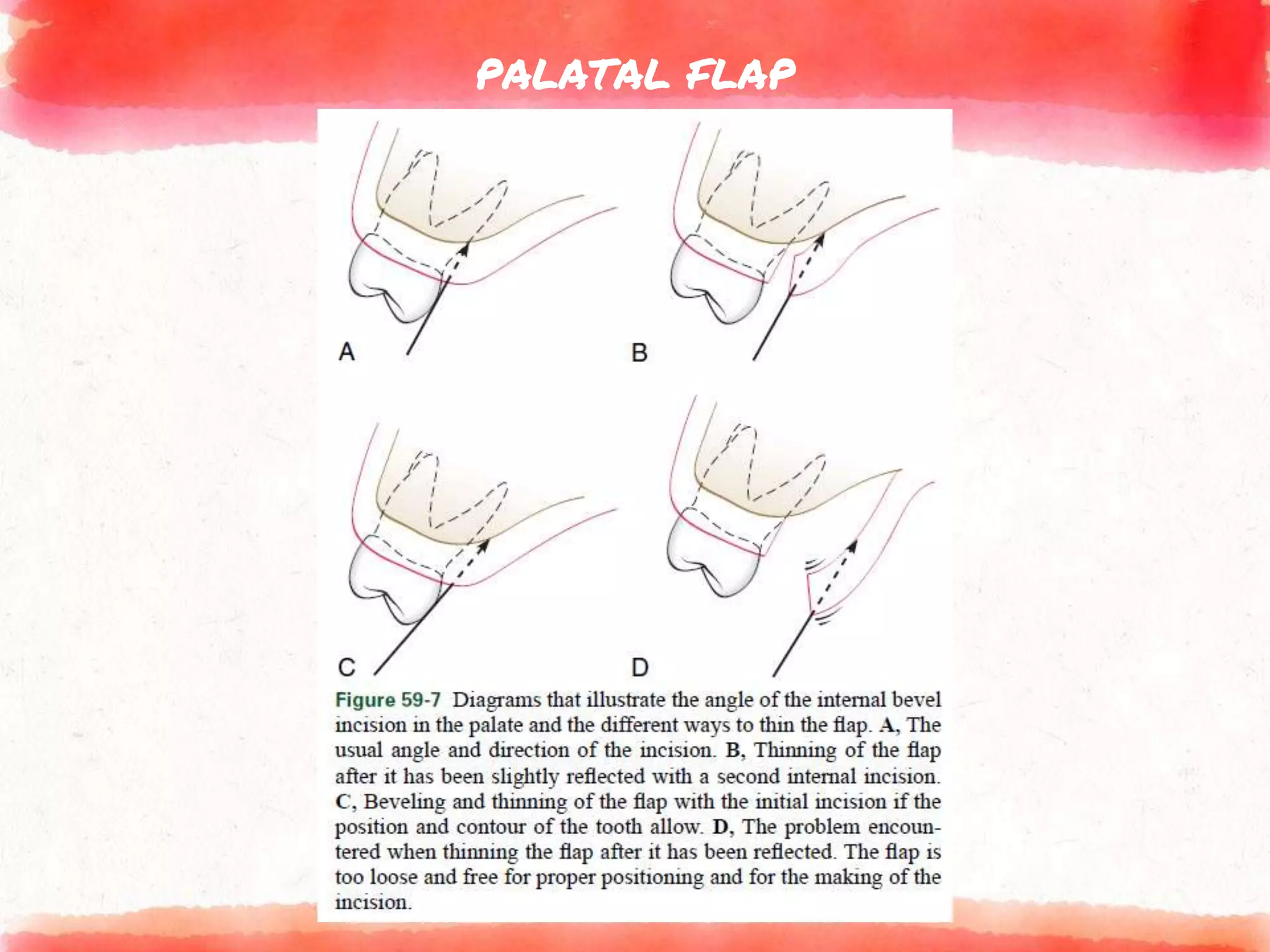 Periodontal flap surgery | PPTX