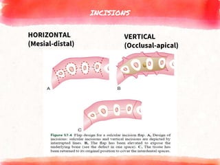 Periodontal flap surgery | PPTX