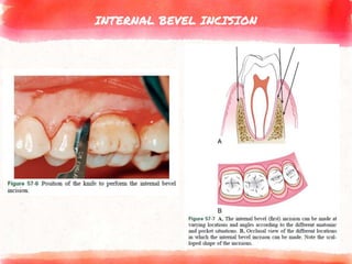 Periodontal flap surgery | PPTX