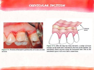 Periodontal flap surgery | PPTX