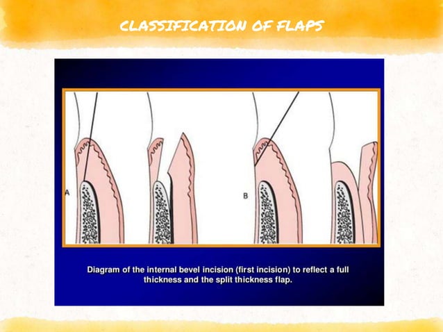 Periodontal flap surgery | PPTX | Dental Health | Diseases and Conditions