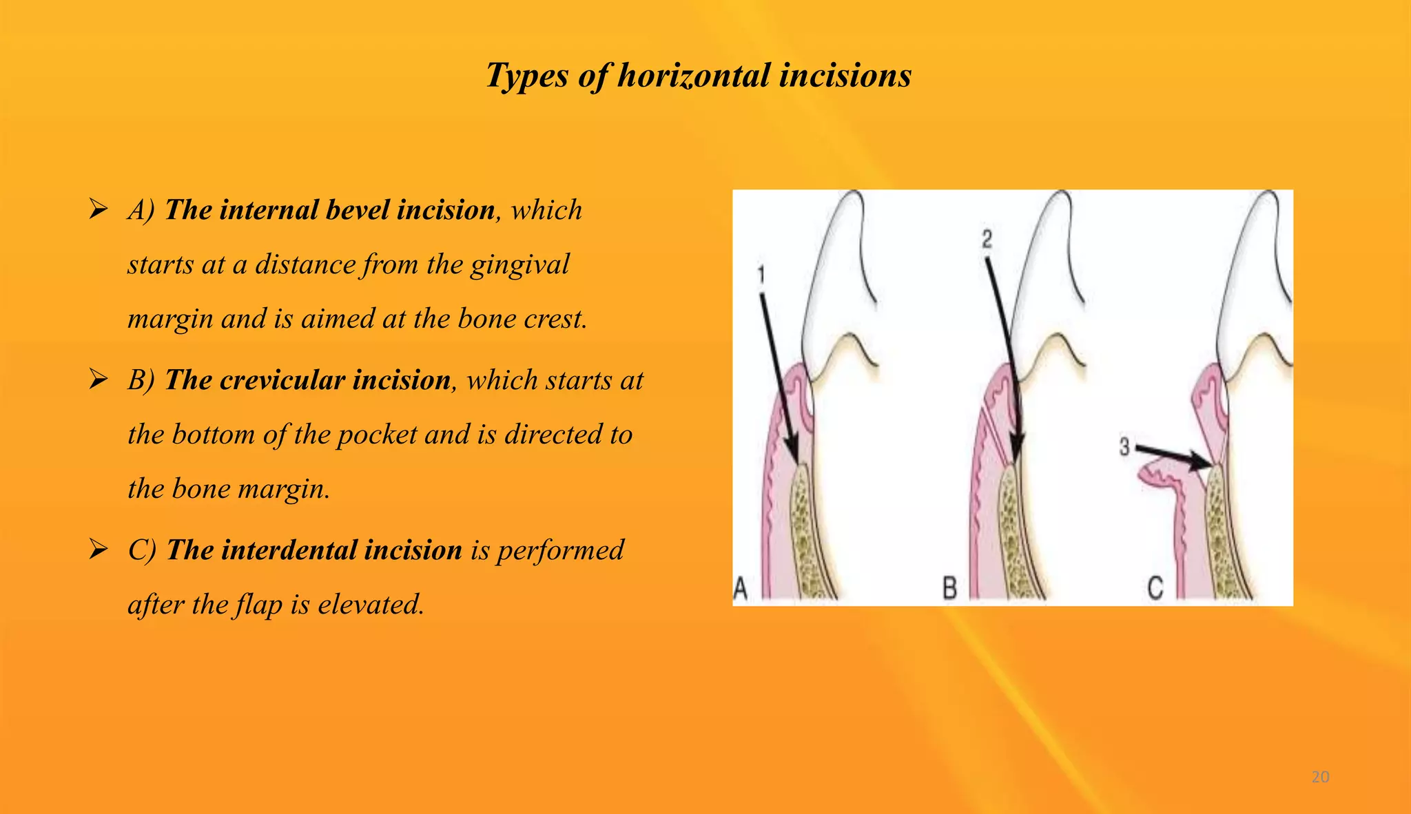 Periodontal flap surgery | PPTX