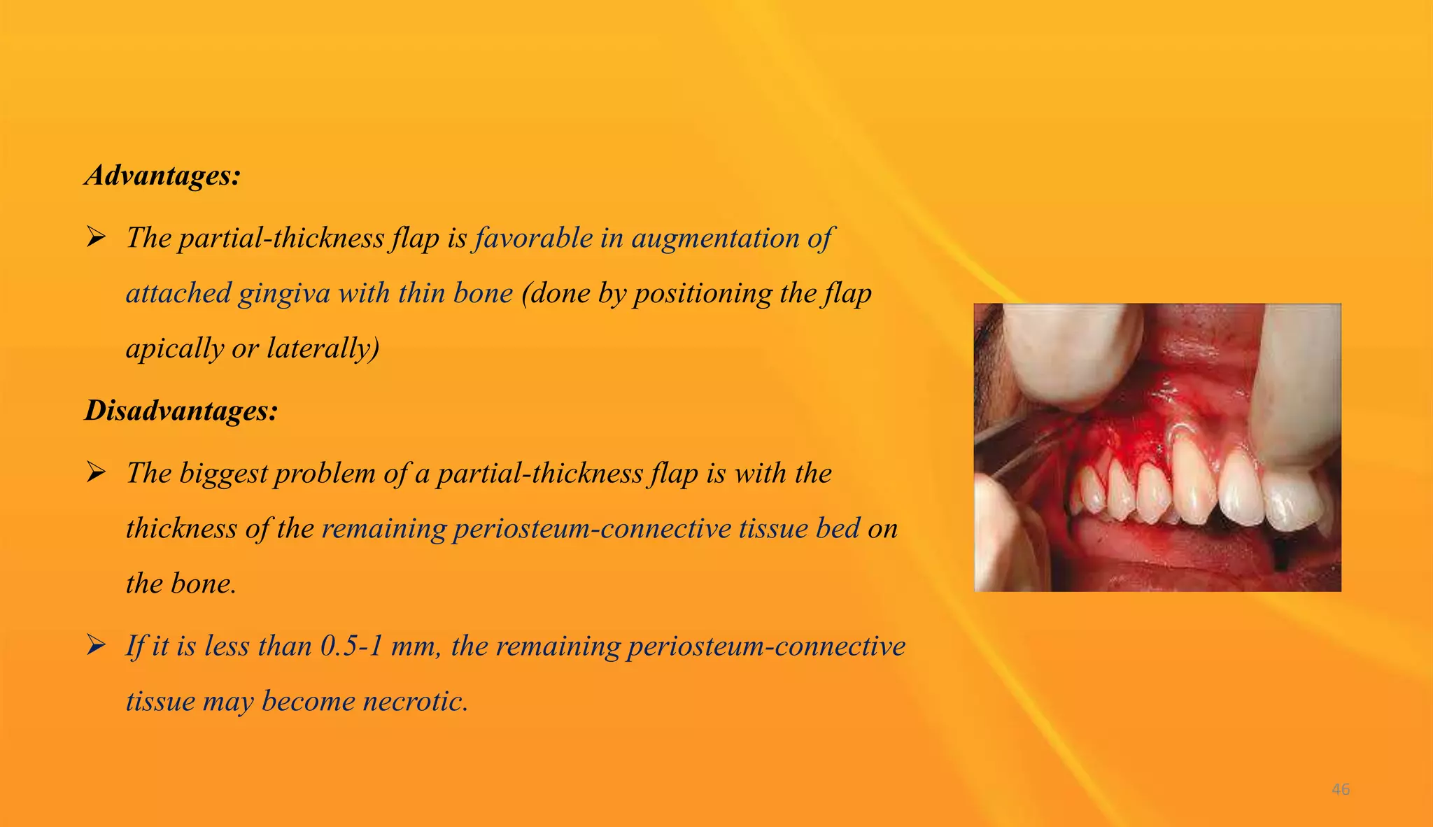Periodontal flap surgery | PPTX