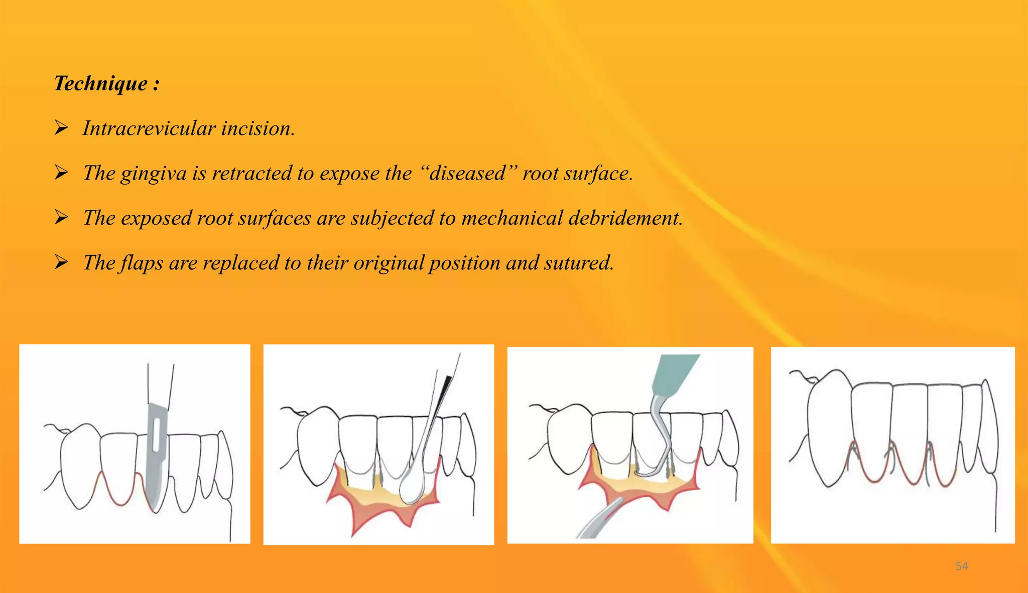 Periodontal flap surgery | PPTX