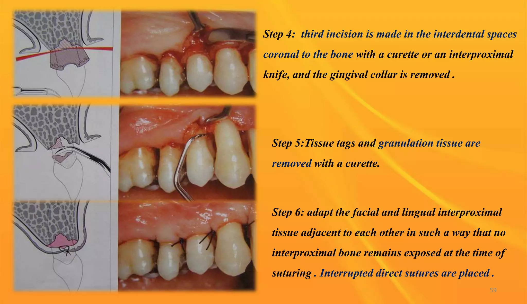 Periodontal flap surgery | PPTX