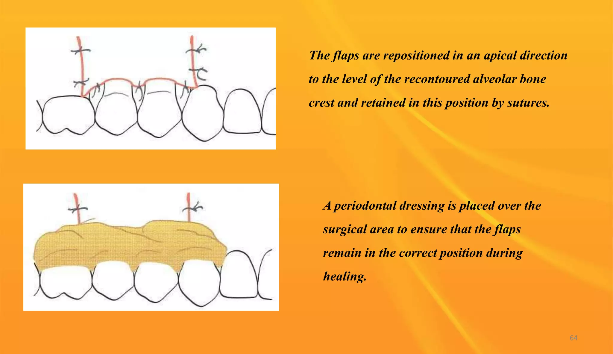 Periodontal flap surgery | PPTX