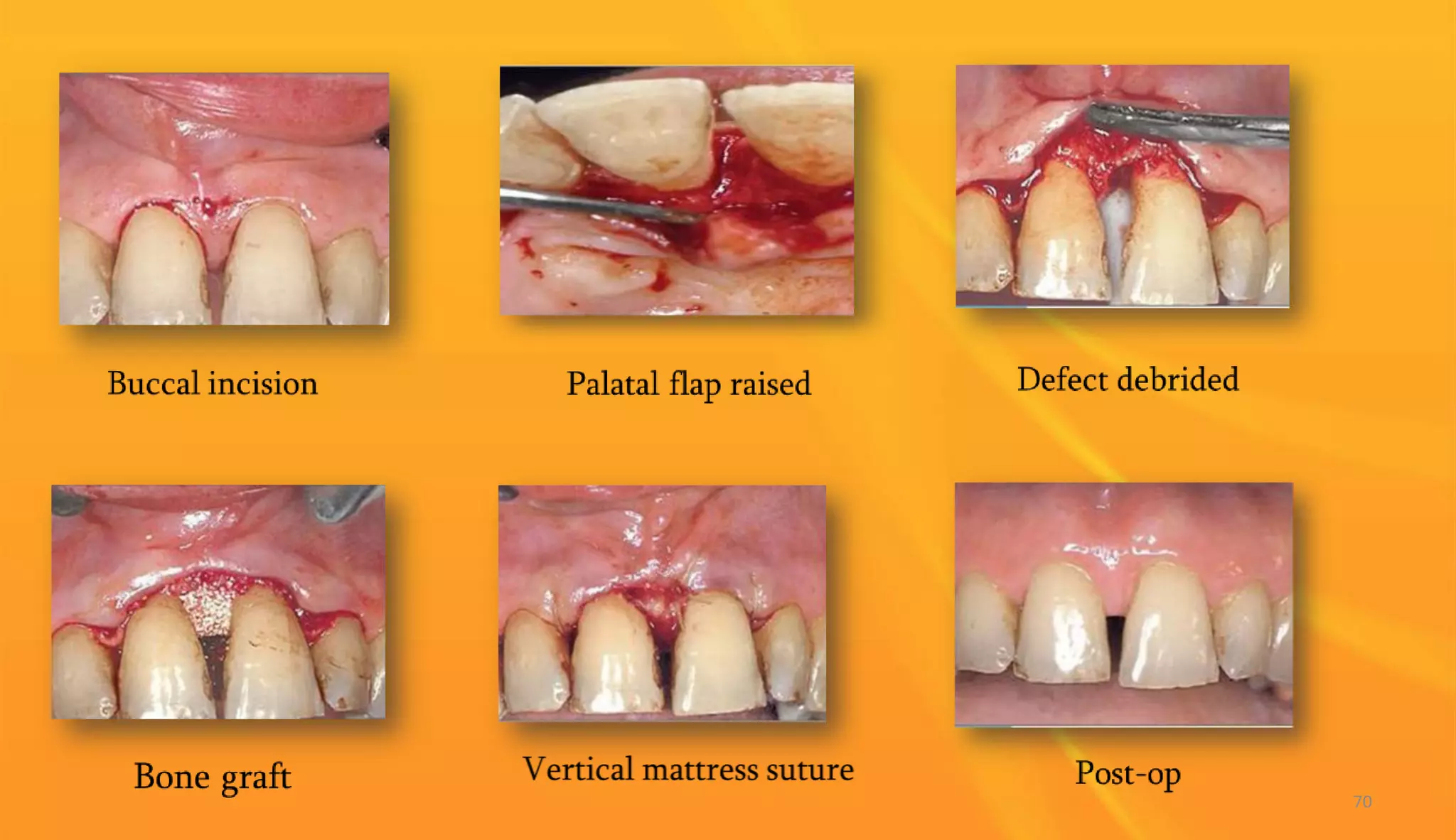 Periodontal flap surgery | PPTX
